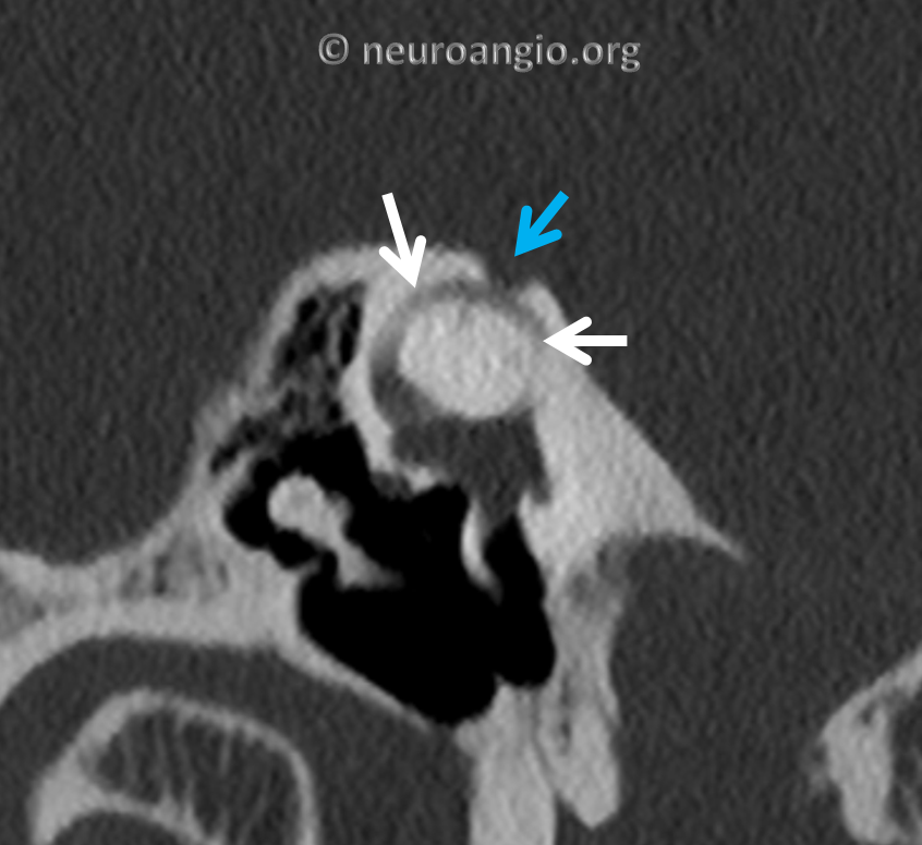 Pulsatile Tinnitus Superior Semicircular Canal Dehiscence | neuroangio.org
